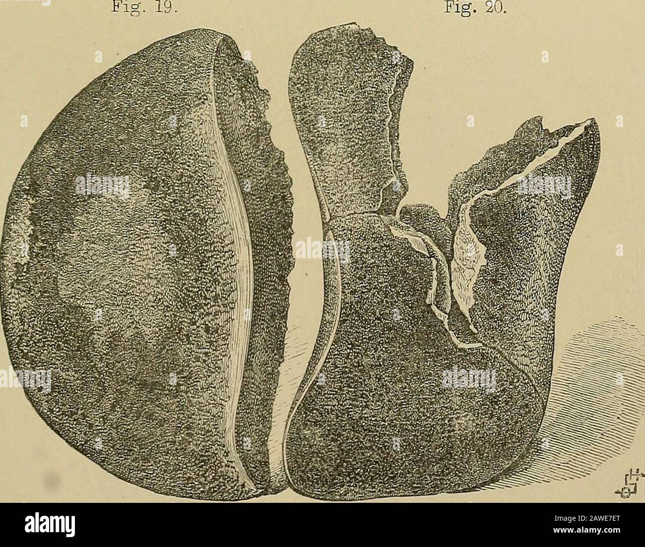 Kidney diseases, urinary deposits, and calculous disorders : their ...