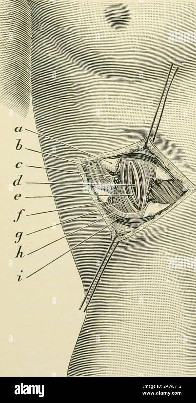 How To Remove A Diaphragm