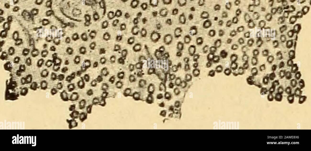 Gummatous syphilis hi-res stock photography and images - Alamy