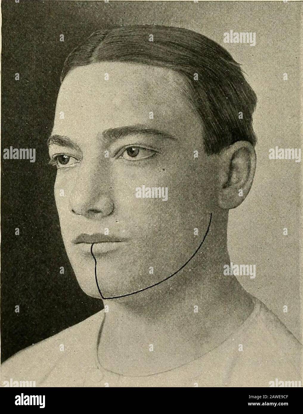 External incision hi-res stock photography and images - Alamy