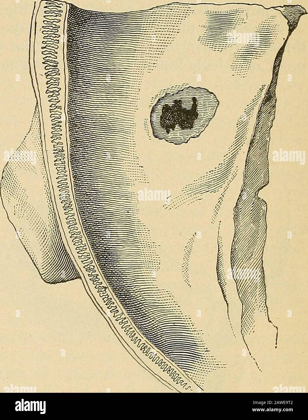 Ear canal abscess hi-res stock photography and images - Alamy