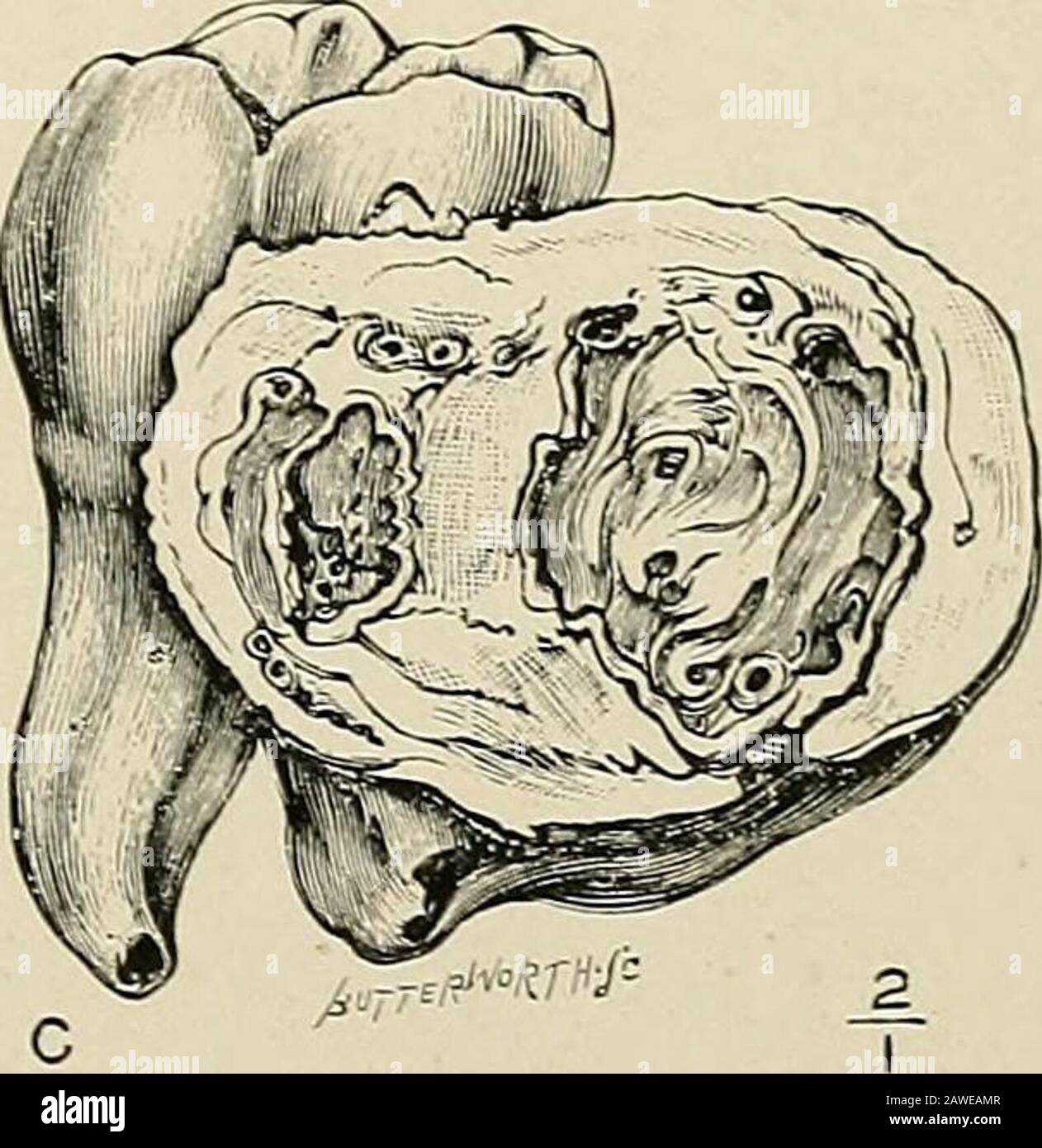 The practice of surgery . Fig. 370.—The second right mandibular molar ...