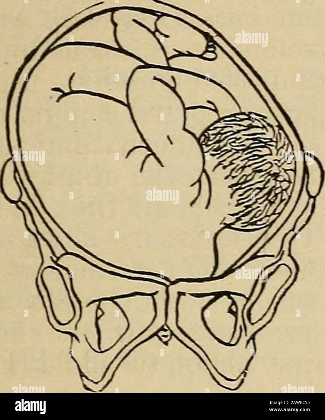 ObstetricsA manual for students and practitioners . Pelvic fresentatiou ...