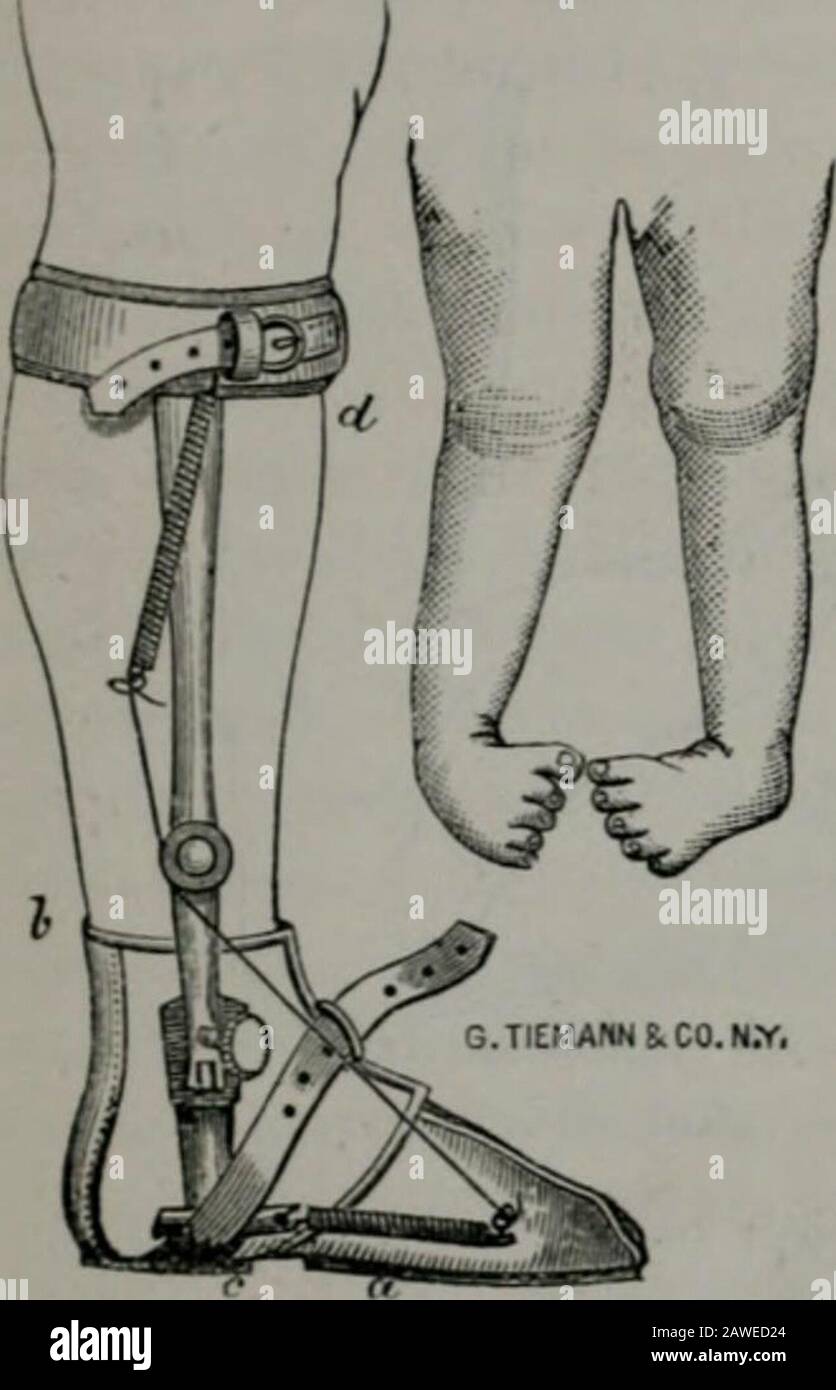 Talipes valgus hi-res stock photography and images - Alamy