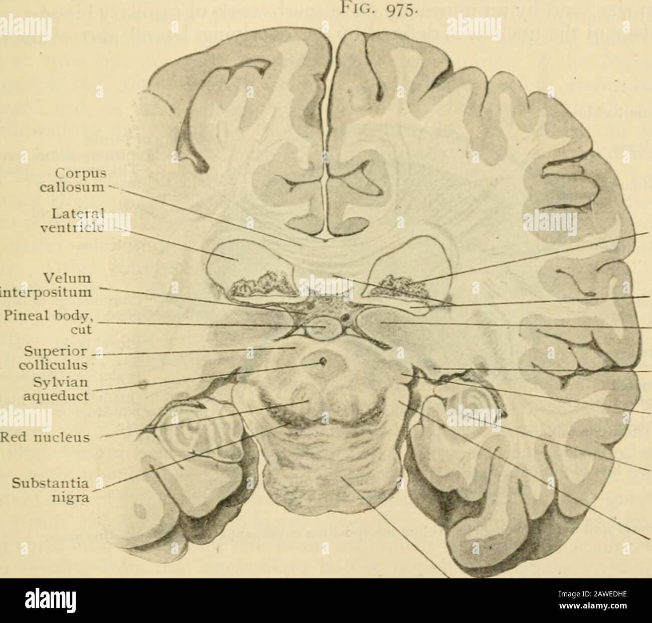 Medial Geniculate Nucleus Coronal