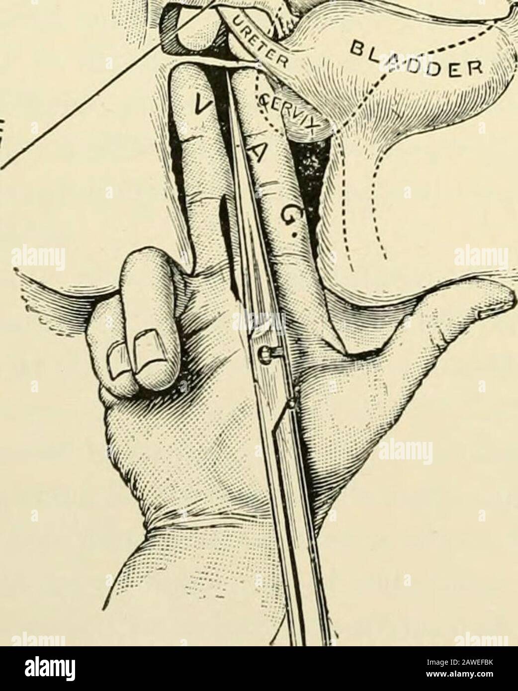 Operative surgery . Ureterectomy.—Ureterectomy is performed in ...