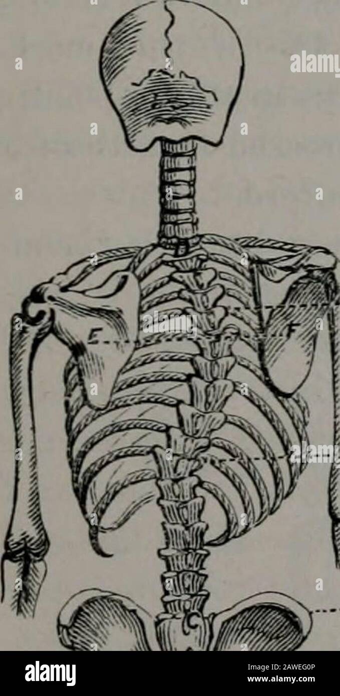 Crooked spine hi-res stock photography and images - Alamy