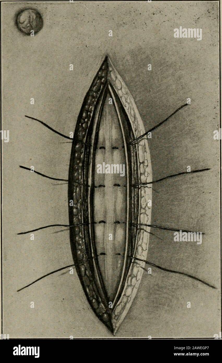 Operative surgery, for students and practitioners . aced in the ...