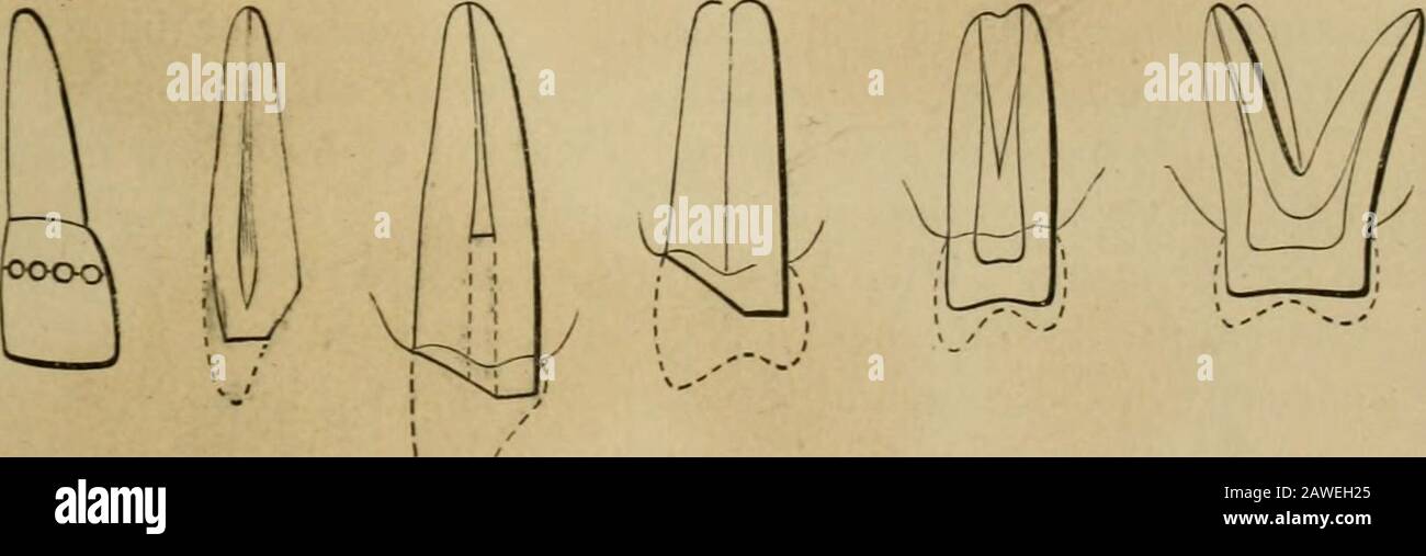 Gum shaft hi-res stock photography and images - Alamy
