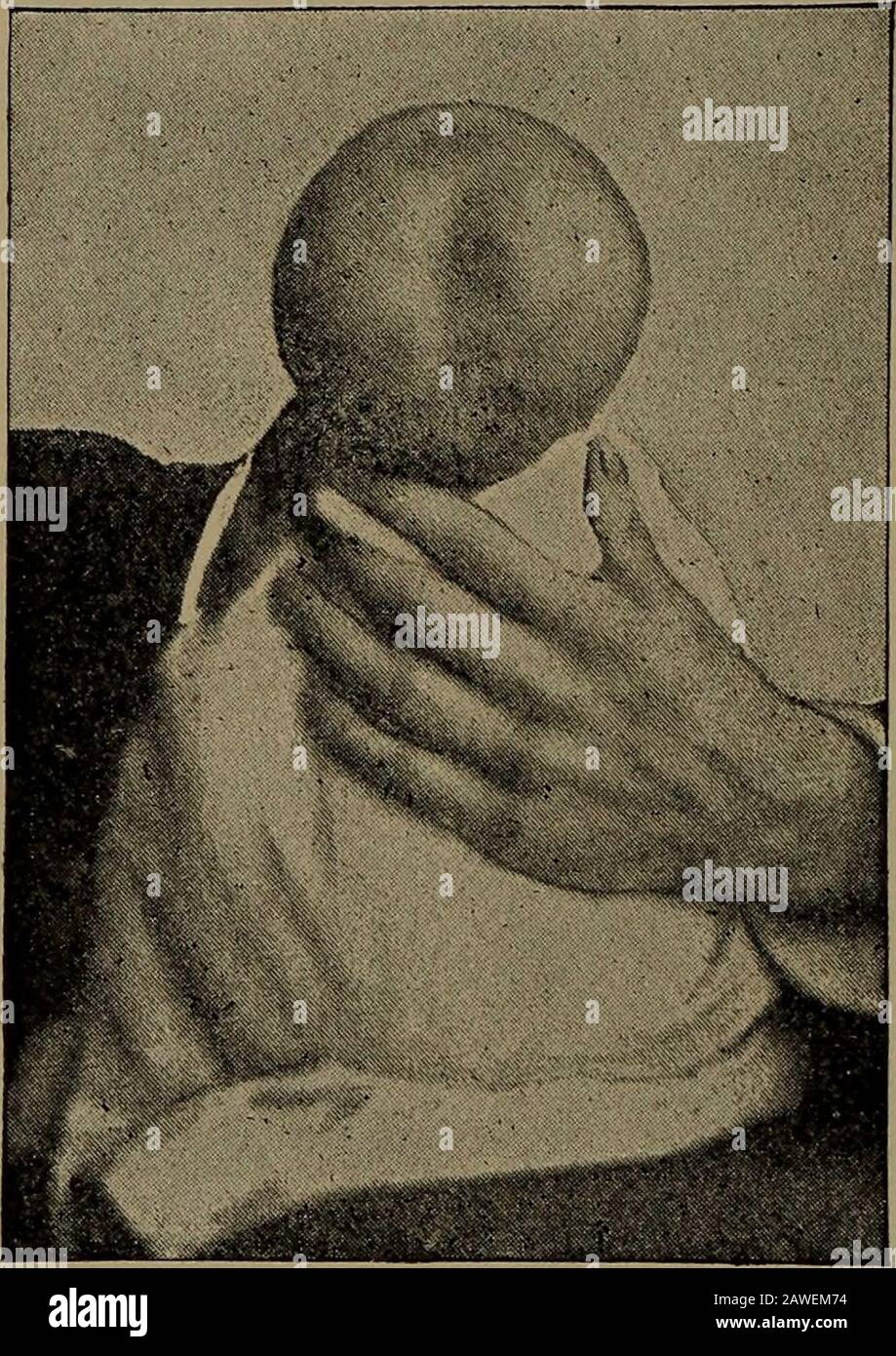 Caput succedaneum hi-res stock photography and images - Alamy