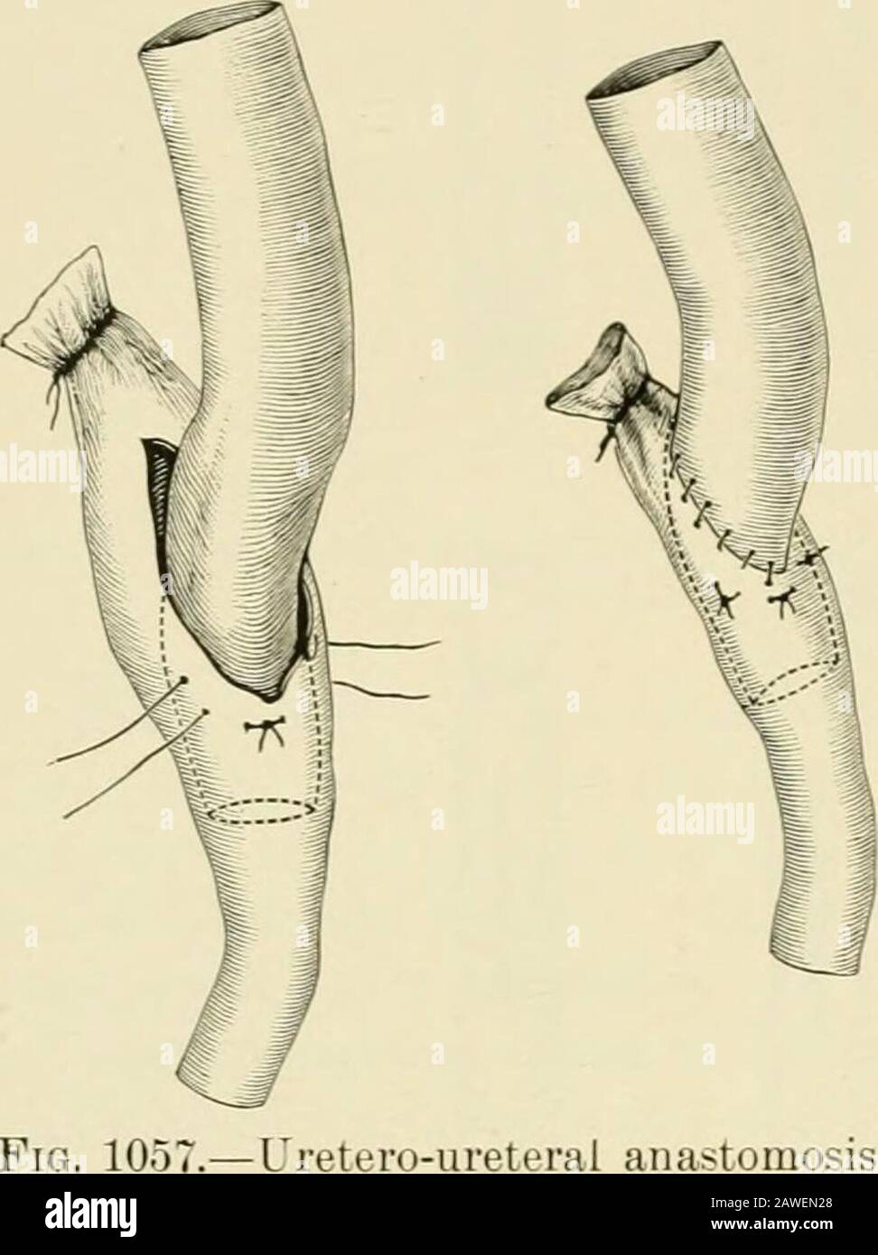 Operative surgery . line of union. Two needles, each armed with a ...
