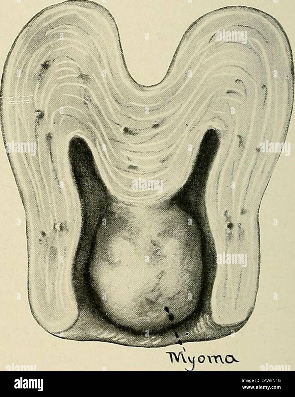 Gynecology . jomcx Fig. 188.—Myomatous Polyp. Distinguished from ...