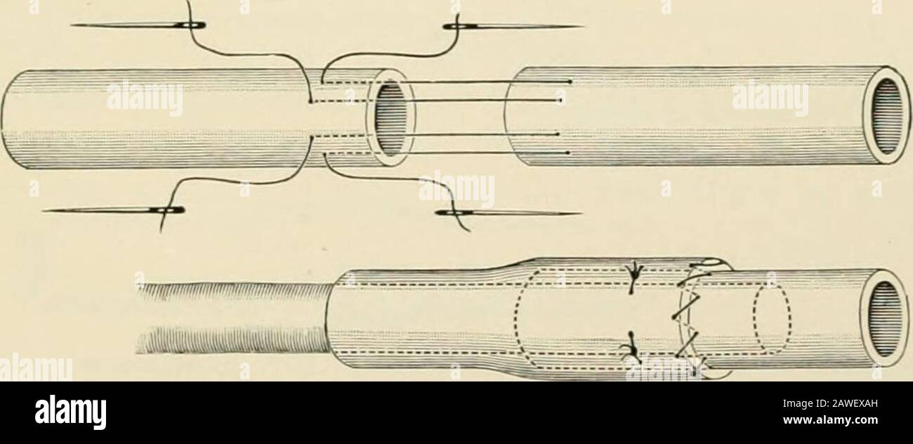 Distal ureter hi-res stock photography and images - Alamy