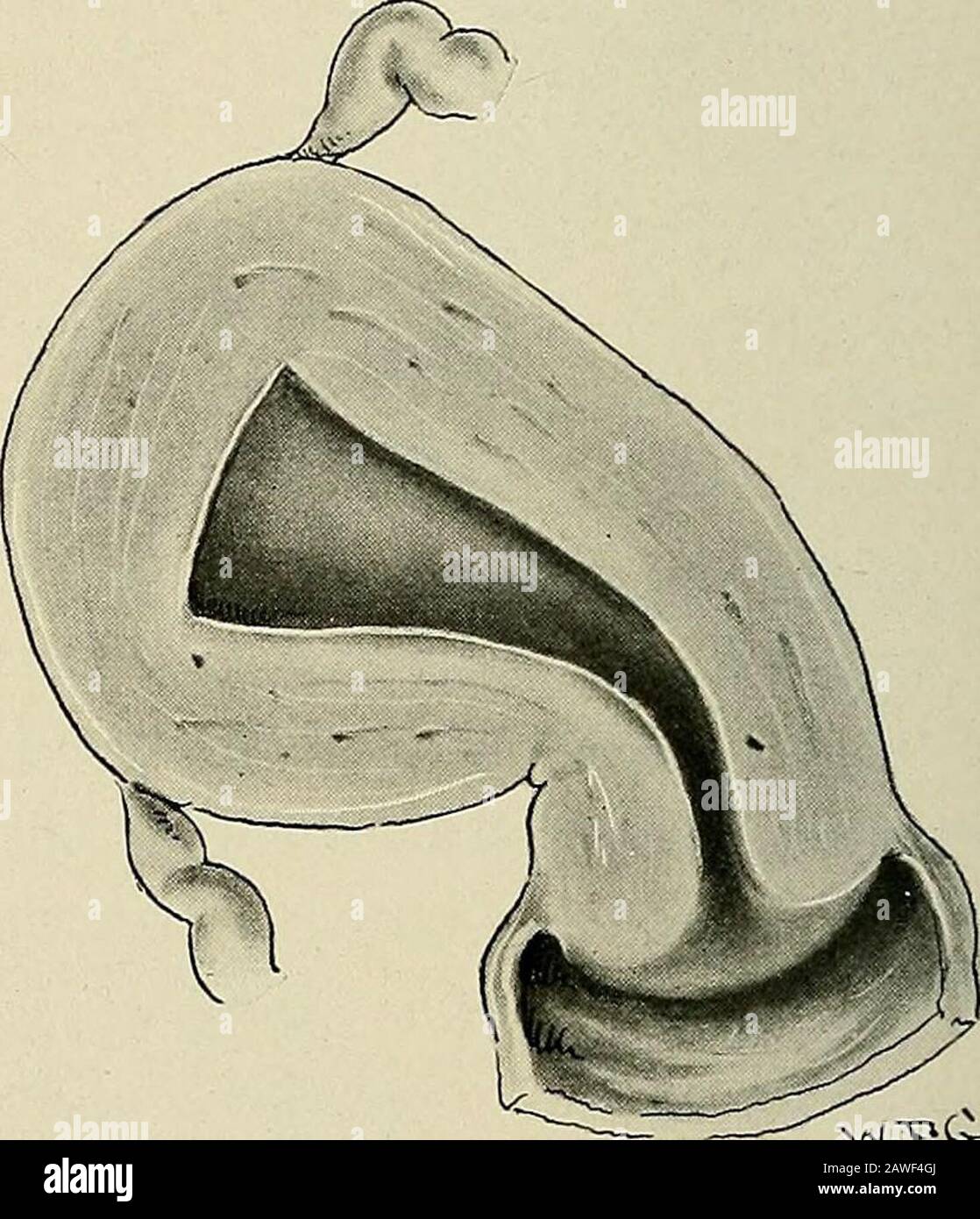 Gynecology . Fig. 179.—Lateral Version.. Fig. 180.—Lateral Flexion ...
