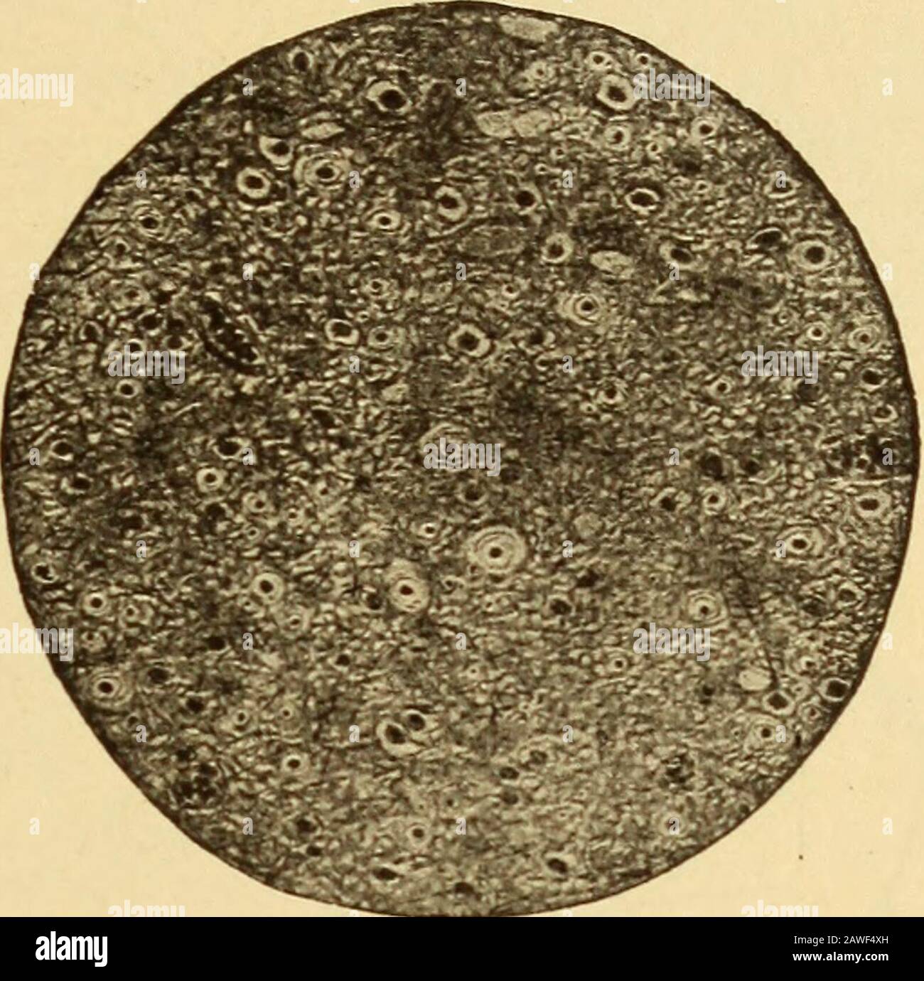 Diseases of the nervous system .. . Fig. 104.—Tabetic Disease of ...