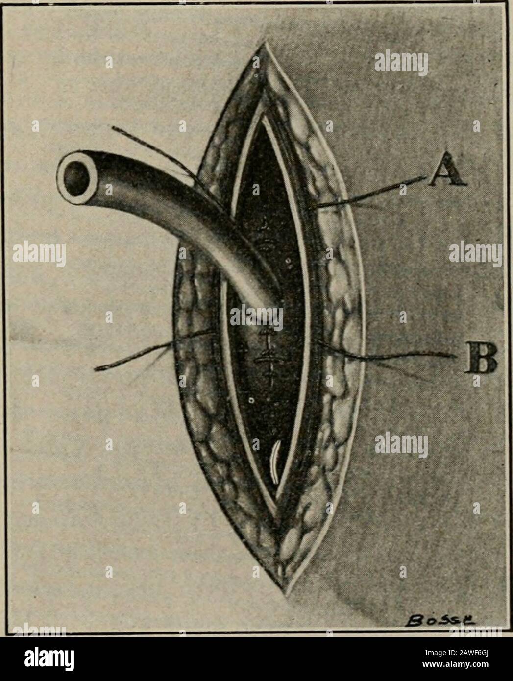 Purse string suture hi-res stock photography and images - Alamy
