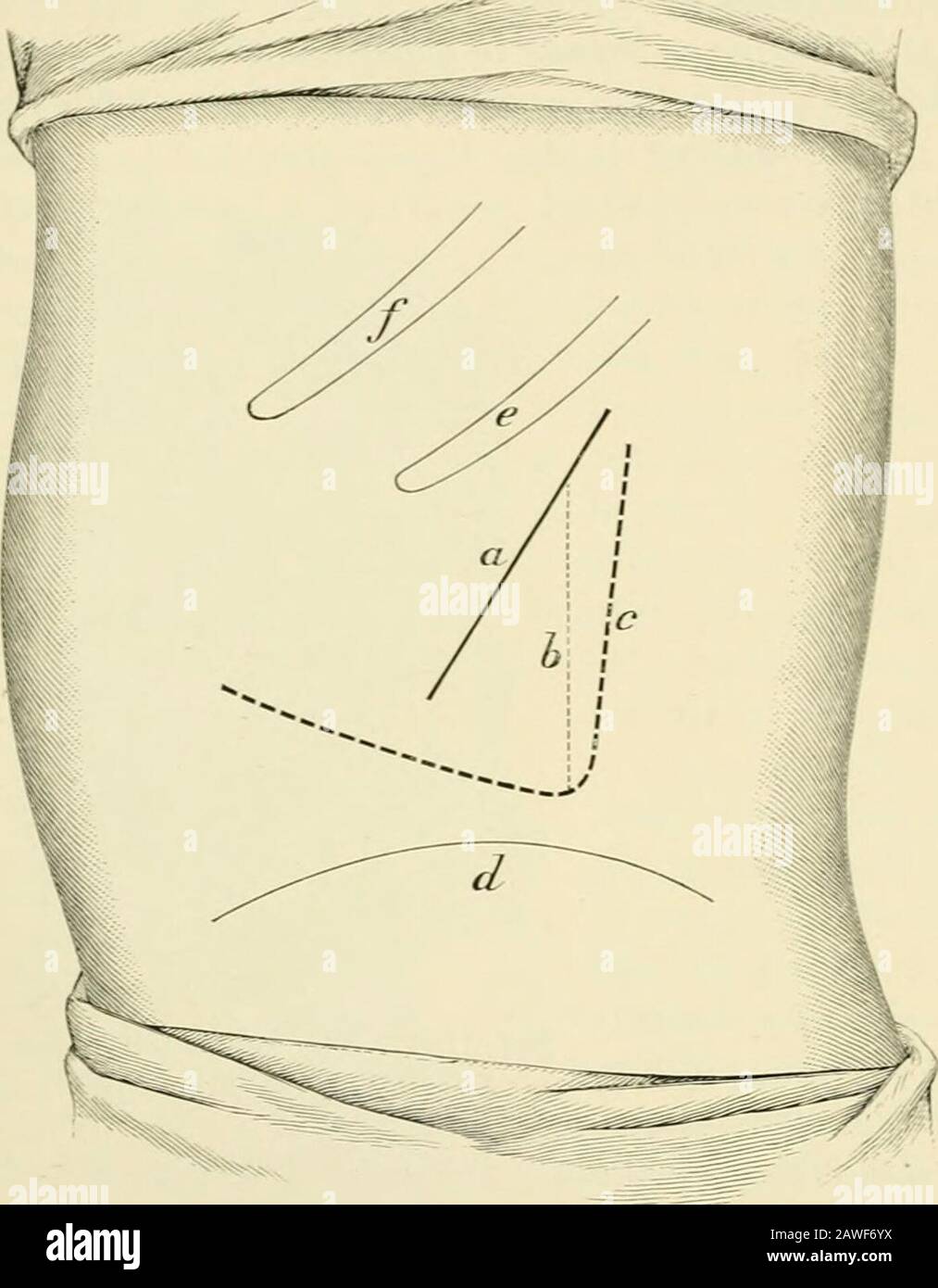 Operative surgery . superior spi-nous process of theilium, and retract ...