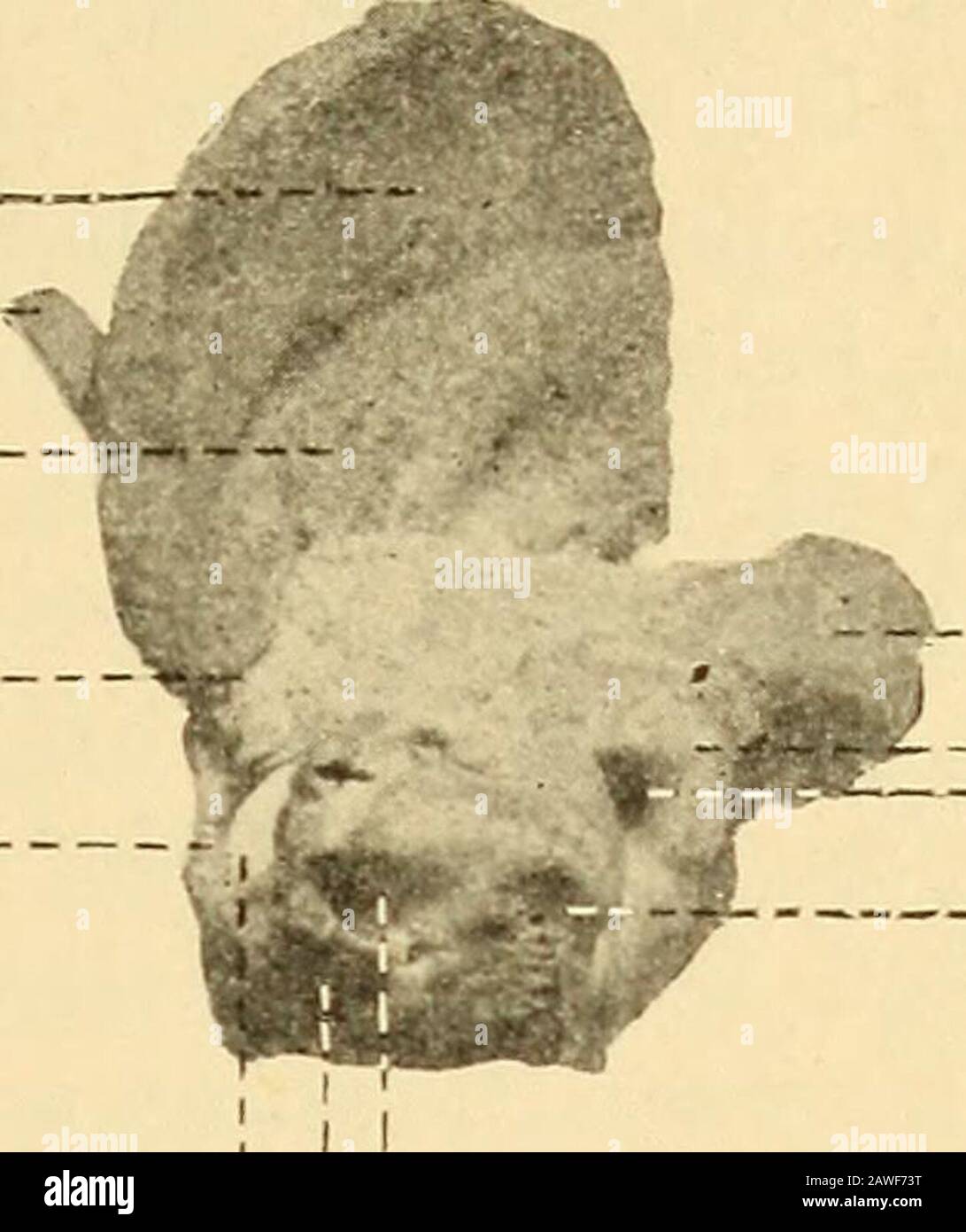 Jugular bulb hi-res stock photography and images - Alamy