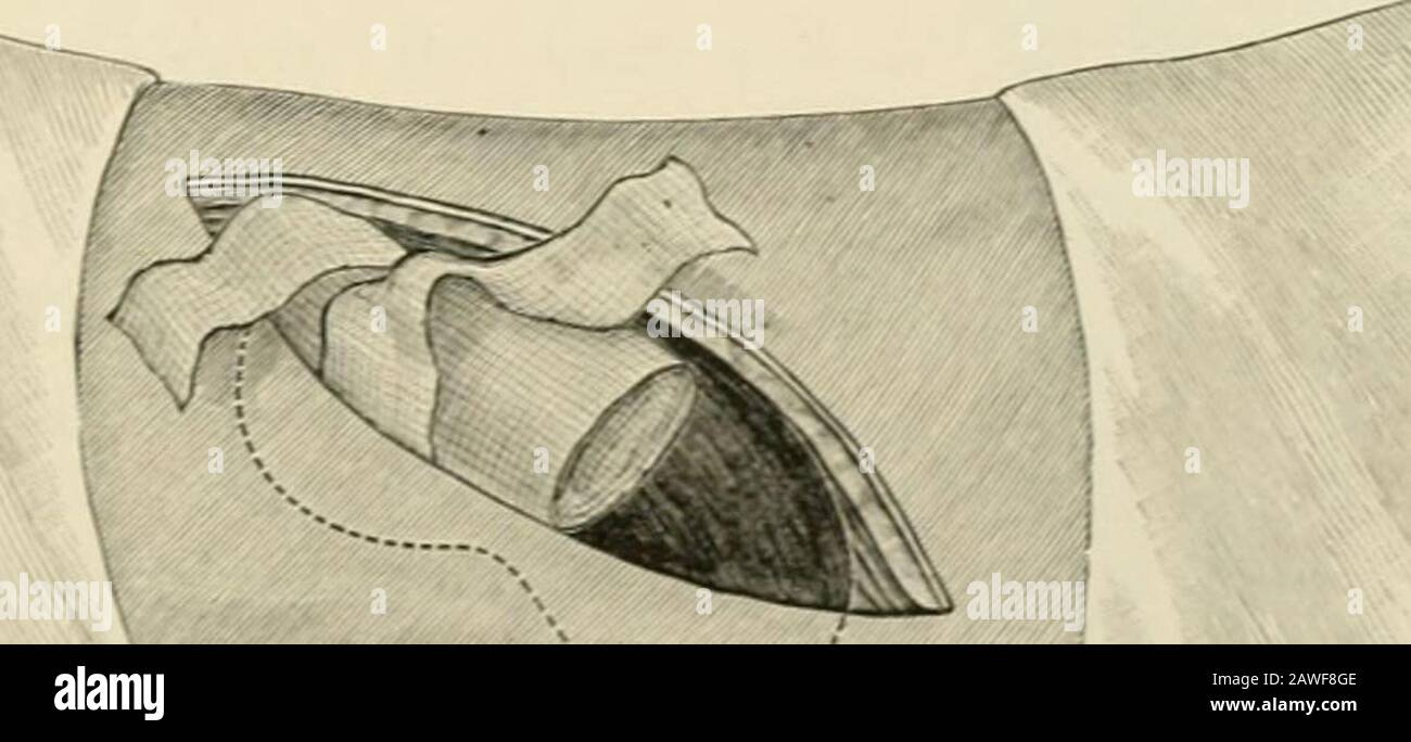 Operative surgery . Fig. 1038.—The operation of nephropexy. Senns ...
