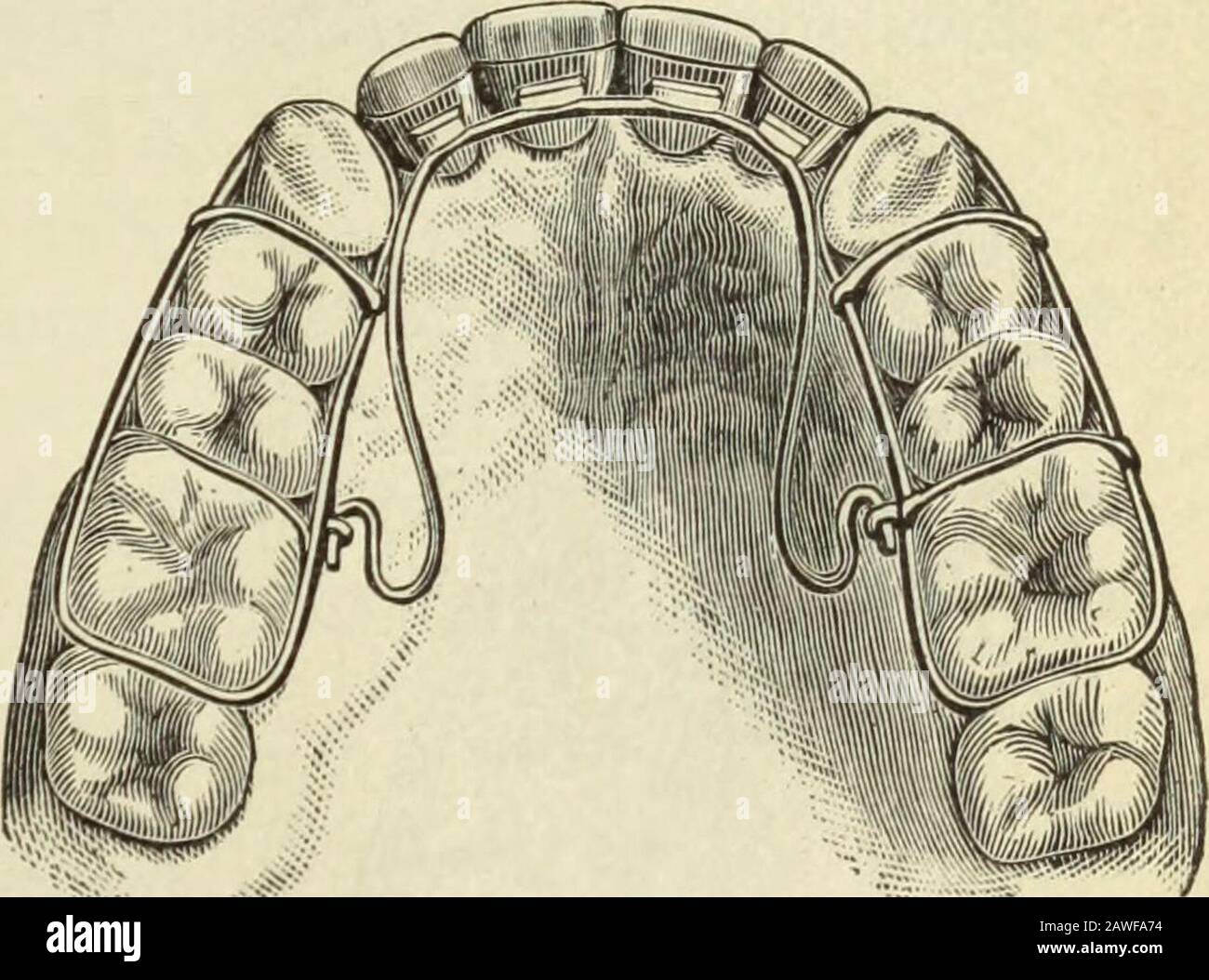 Palatal Holding Arch