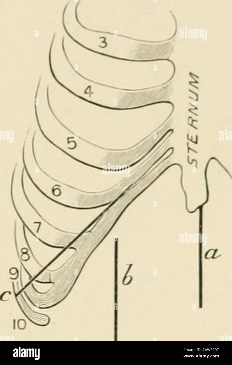 Operative surgery . Fig. 1030.—The resection of costal border.a ...