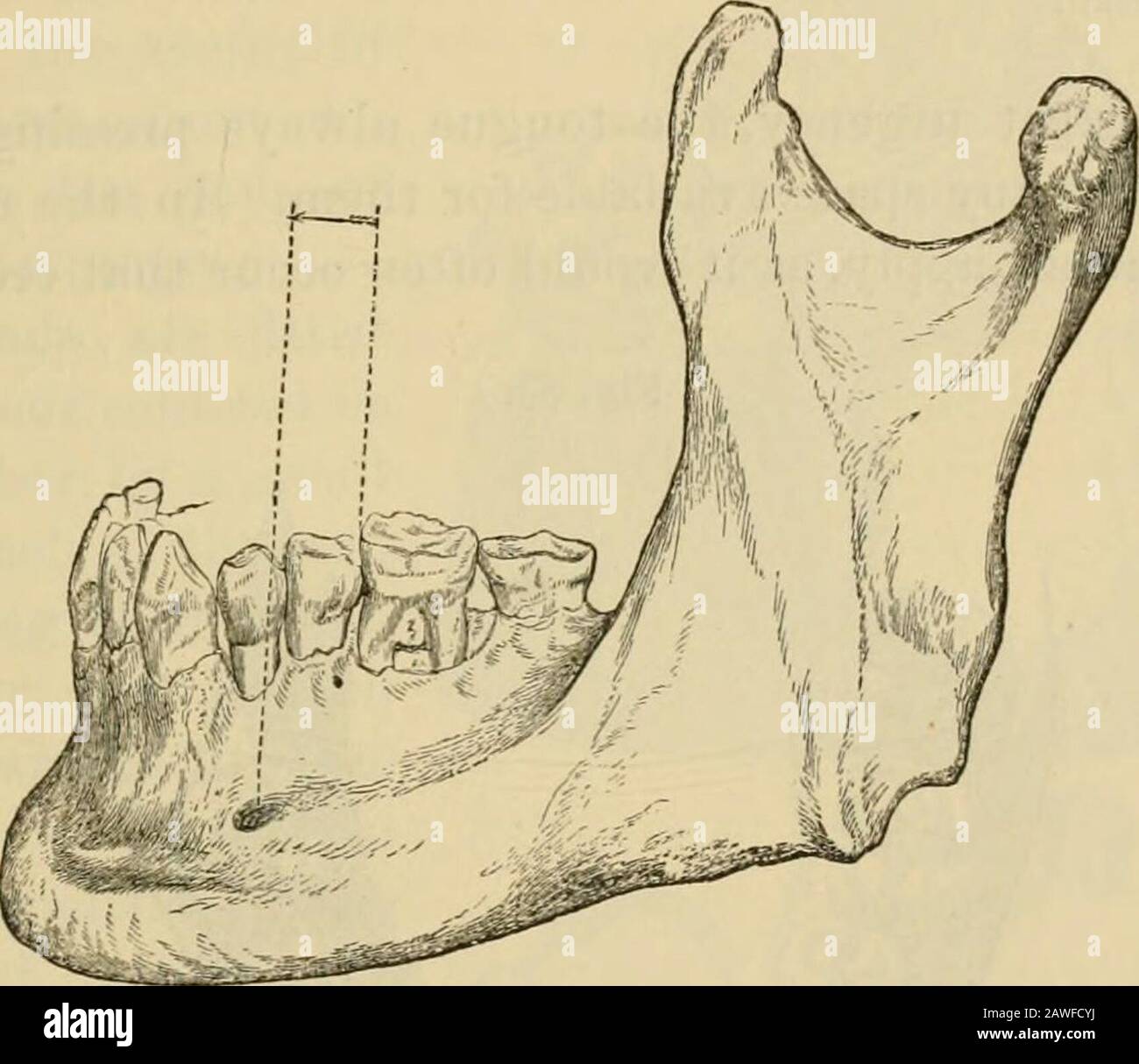 Permanent molars hi-res stock photography and images - Alamy