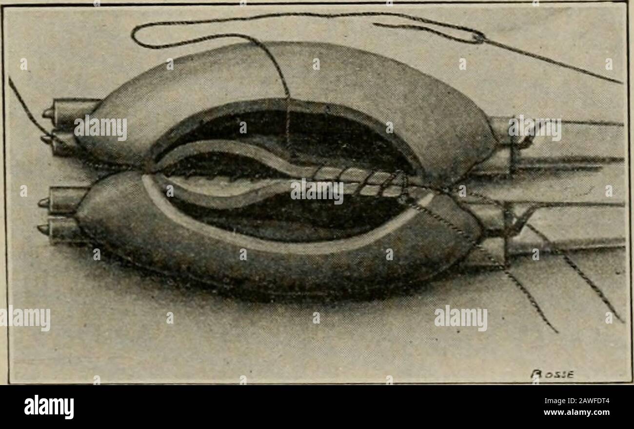 Jejunostomy hi-res stock photography and images - Alamy
