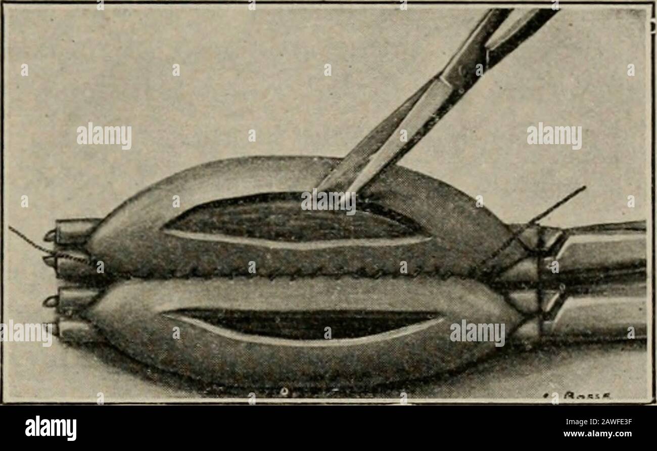 Jejunostomy hi-res stock photography and images - Alamy
