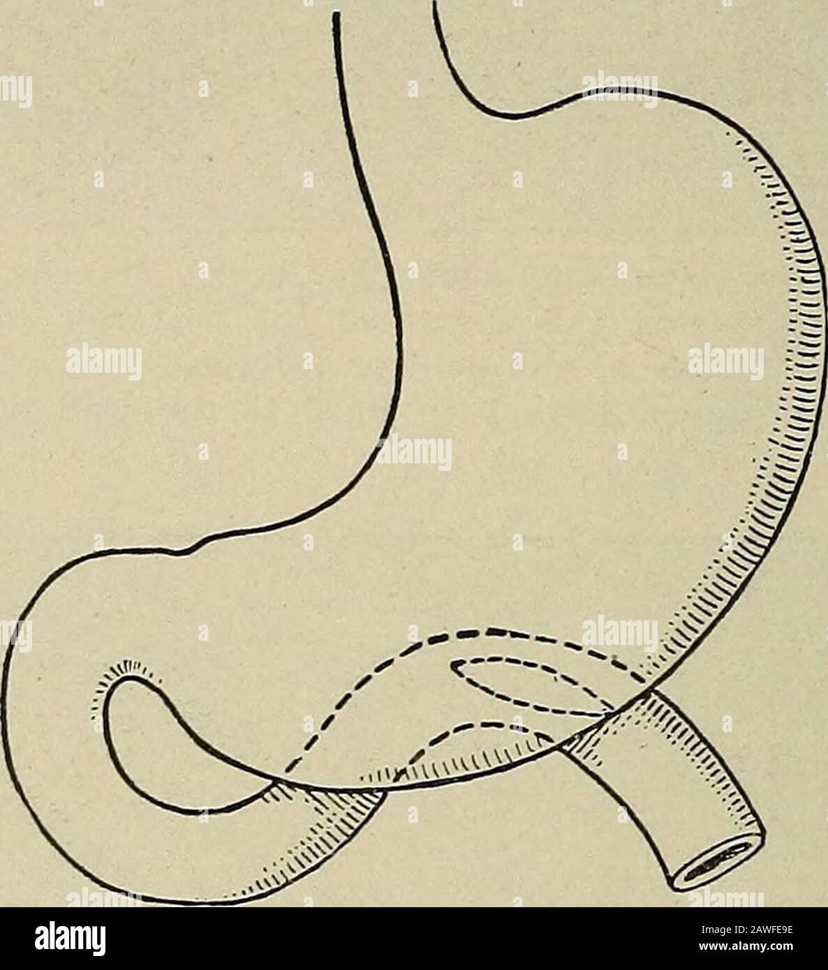 Jejunostomy hi-res stock photography and images - Alamy