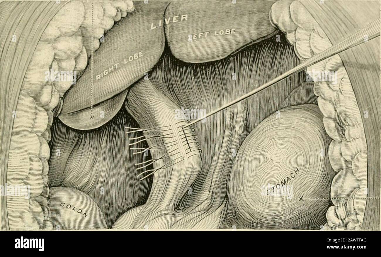 Thickened bladder wall hi-res stock photography and images - Alamy