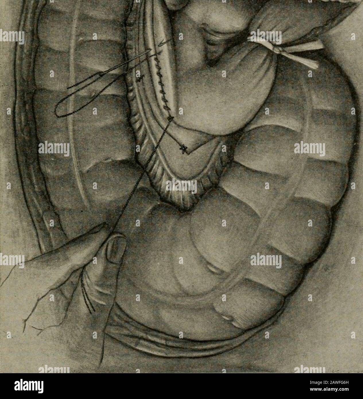 Transverse mesocolon hi-res stock photography and images - Alamy