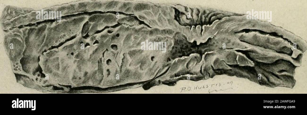 The practice of surgery . Fig. 318.—External appearance of scirrhous ...