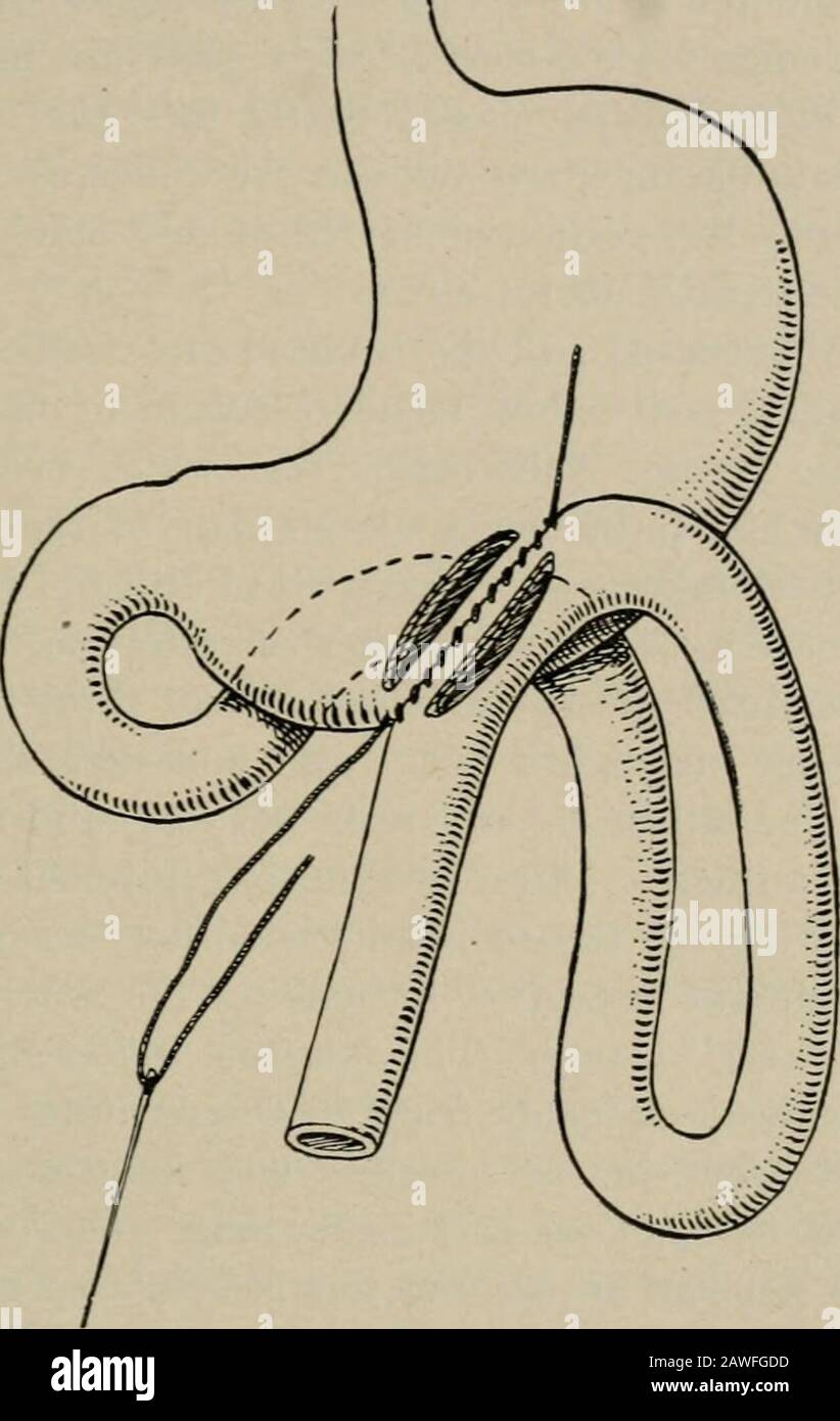 Operative surgery, for students and practitioners . art of thegut lies ...