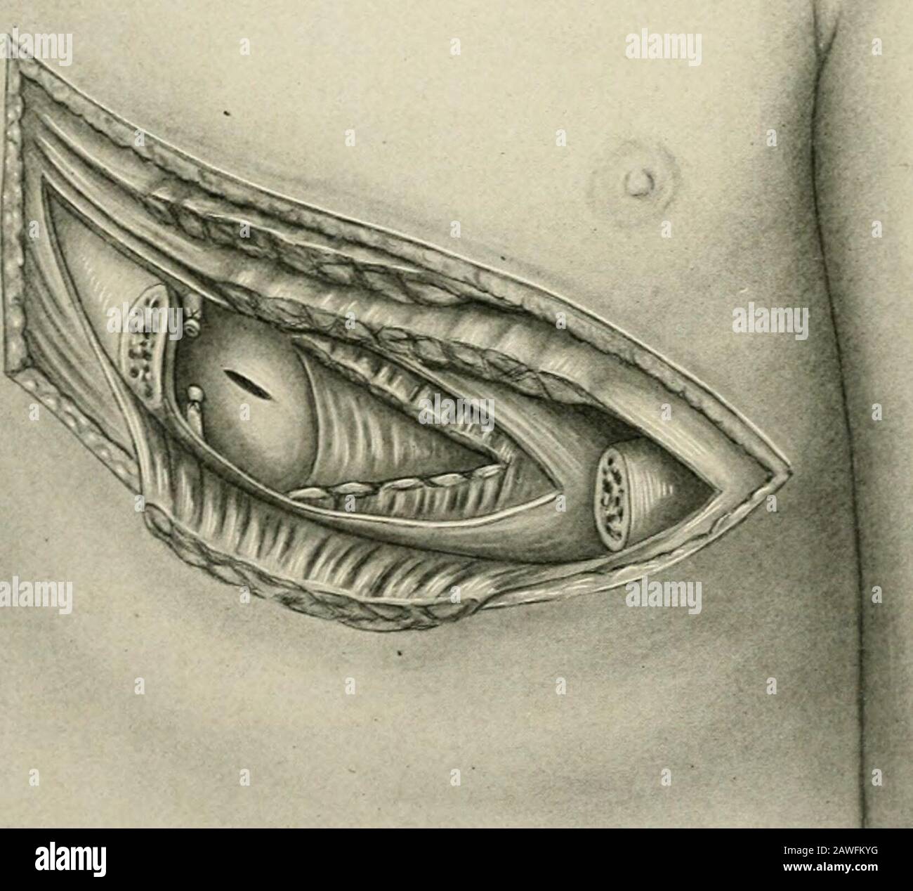 The practice of surgery . ctice in these days limits puncture of the ...
