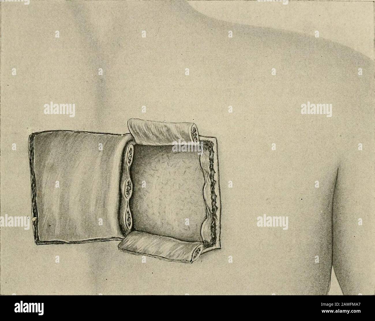 Pyothorax hi-res stock photography and images - Alamy