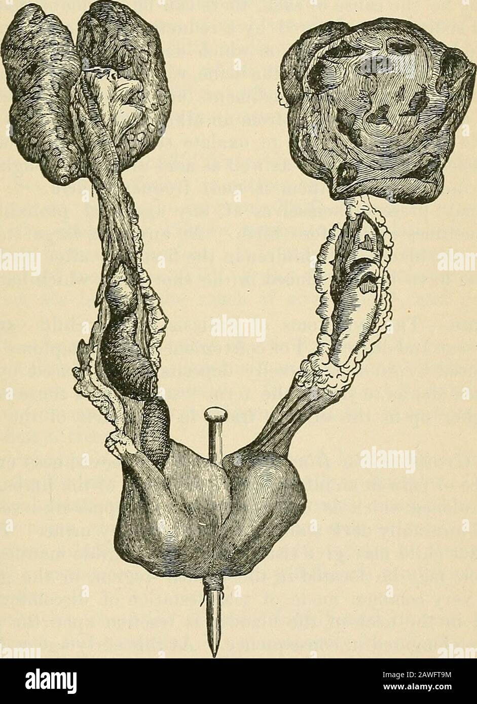 Uric acid stones hi-res stock photography and images - Alamy