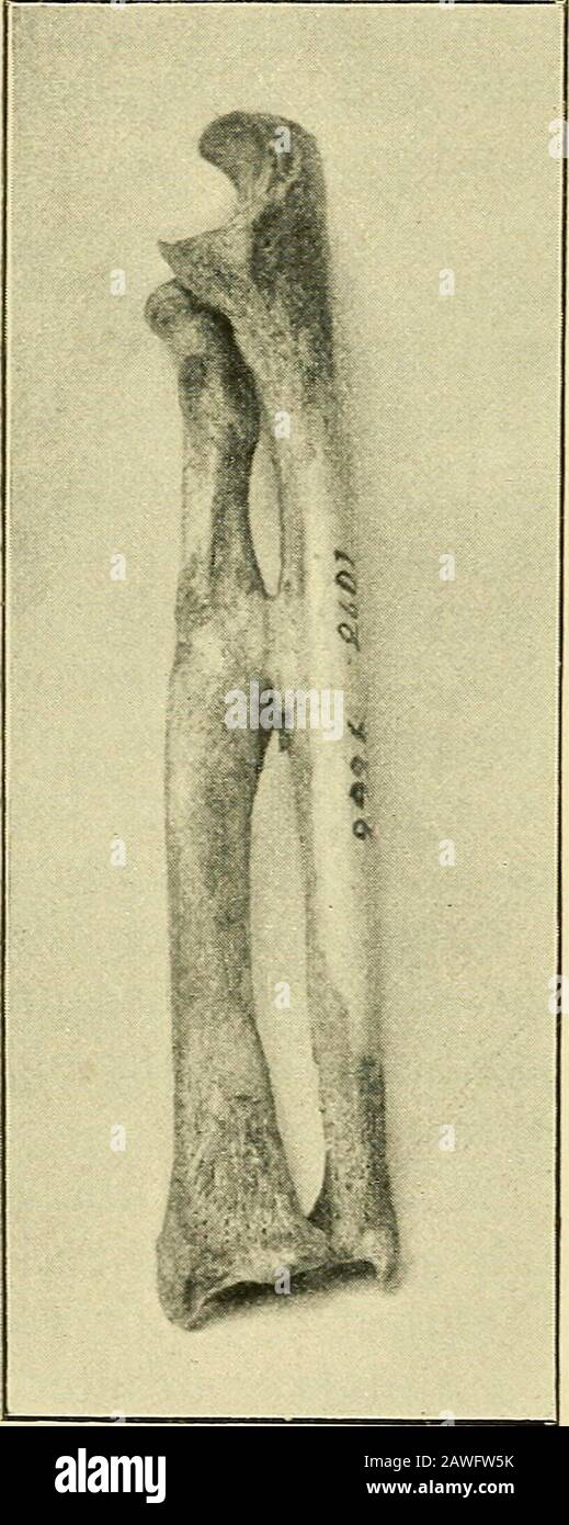 Pyaemia High Resolution Stock Photography and Images - Alamy