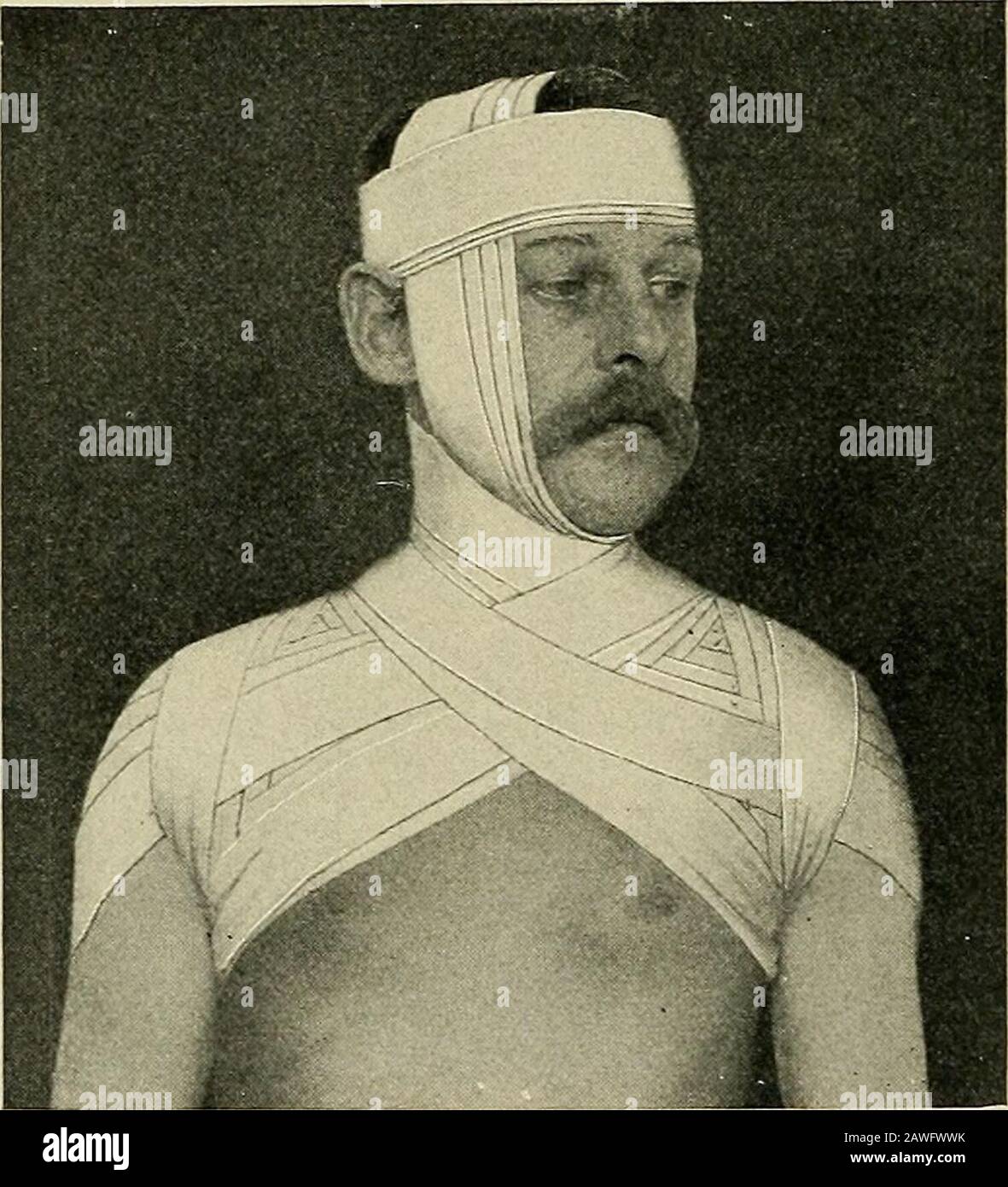 Spica bandage hi-res stock photography and images - Alamy