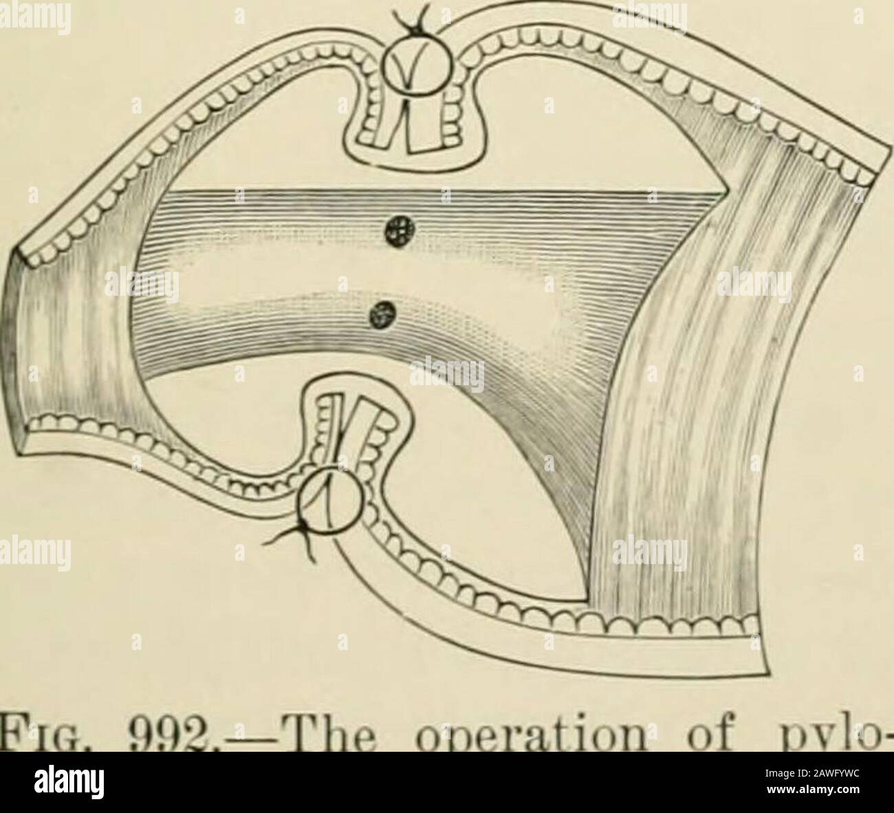 Operative surgery . Fig. 991.—The operation of pylorectomy. Duo-denum ...