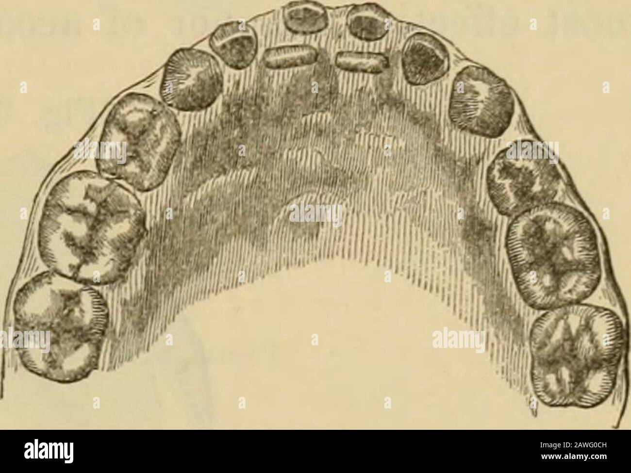 Permanent tooth eruption hi-res stock photography and images - Alamy
