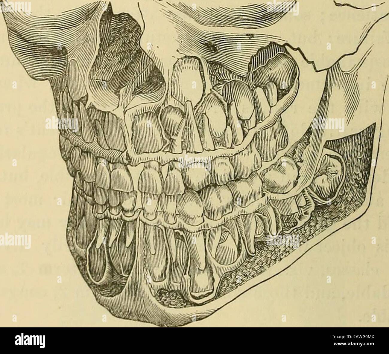 Abnormal teeth hi-res stock photography and images - Alamy