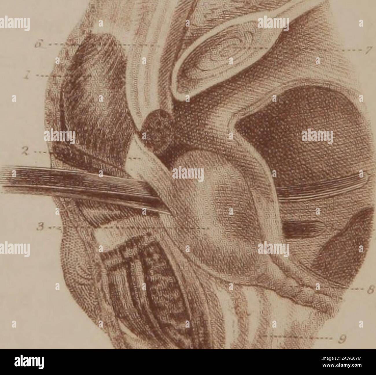 Lithotomy Stock Photos & Lithotomy Stock Images - Alamy
