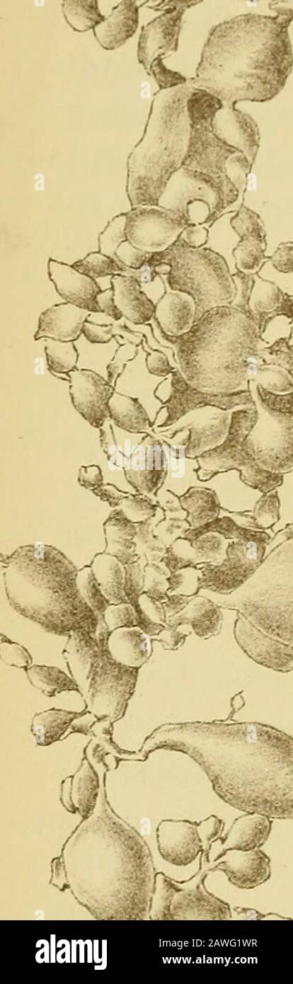 The causes and treatment of abortion . Fig. 15.—Hypertrophied chorion ...