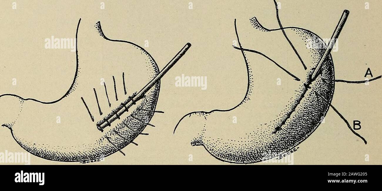 Gastrostomy hi-res stock photography and images - Alamy