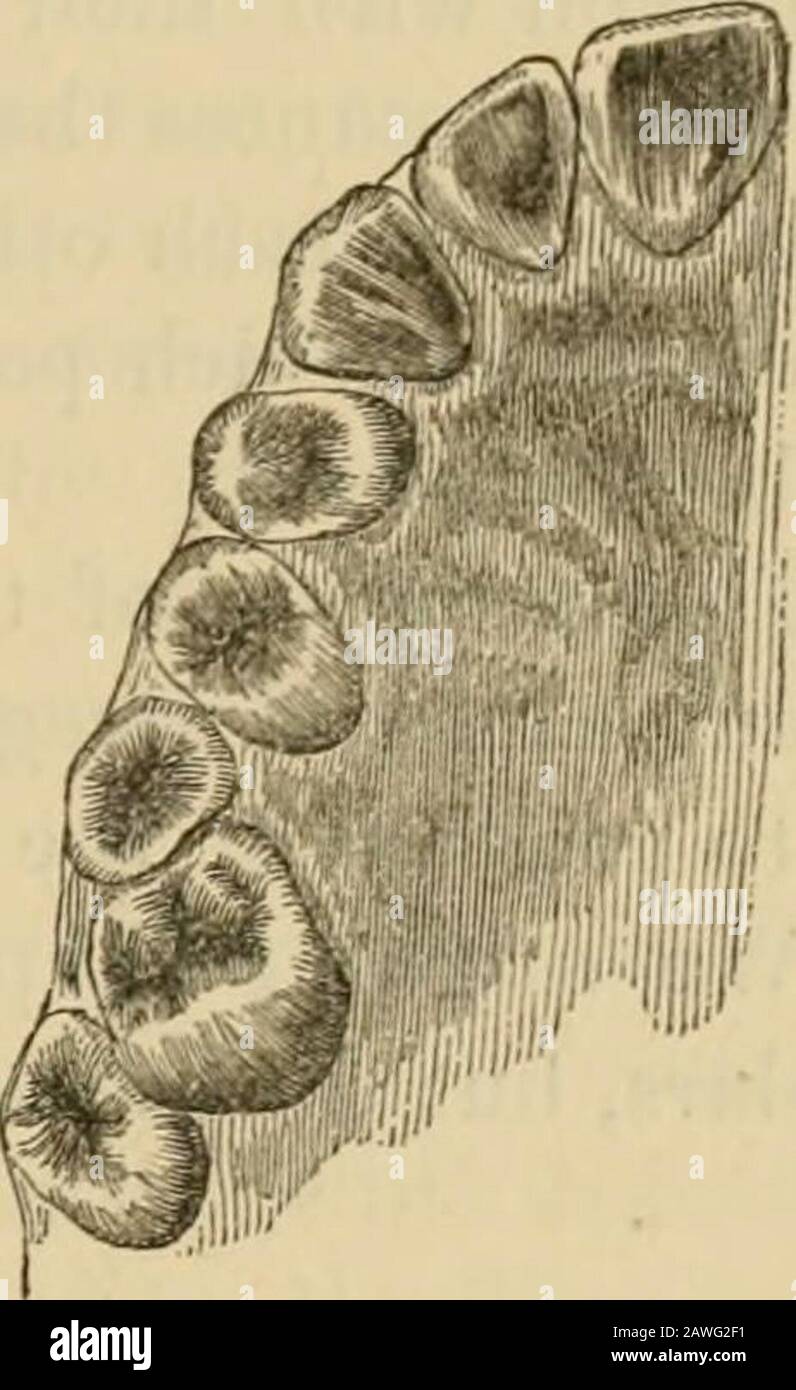 Supernumerary teeth hi-res stock photography and images - Alamy