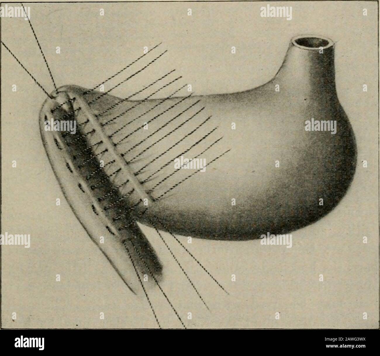 Stomach stitches hi-res stock photography and images - Alamy