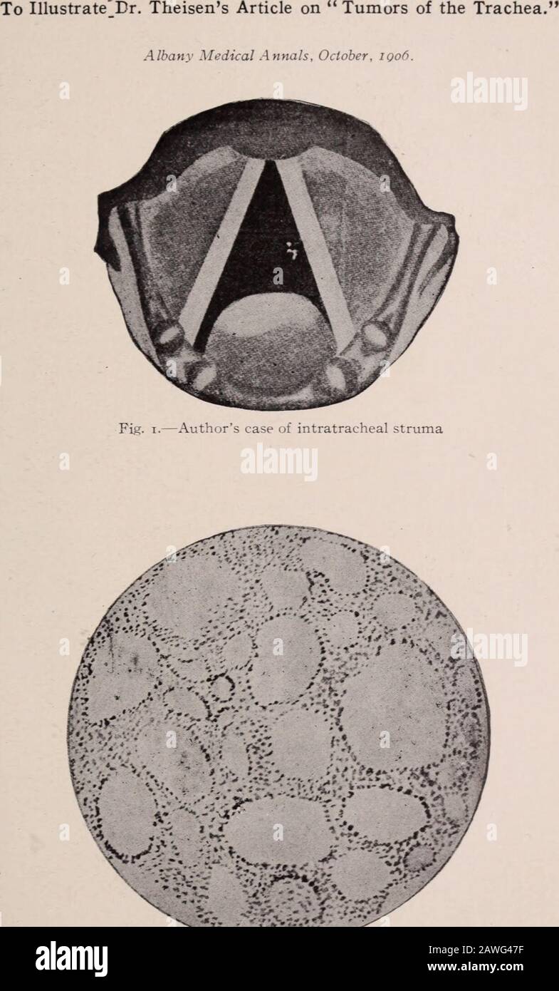 Tracheal ring hi-res stock photography and images - Alamy