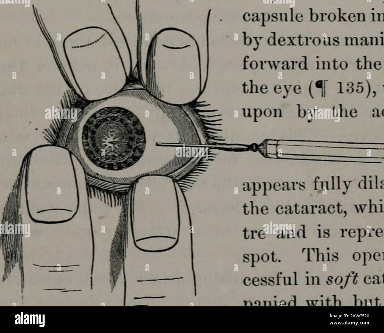 Aqueous humor hi-res stock photography and images - Alamy