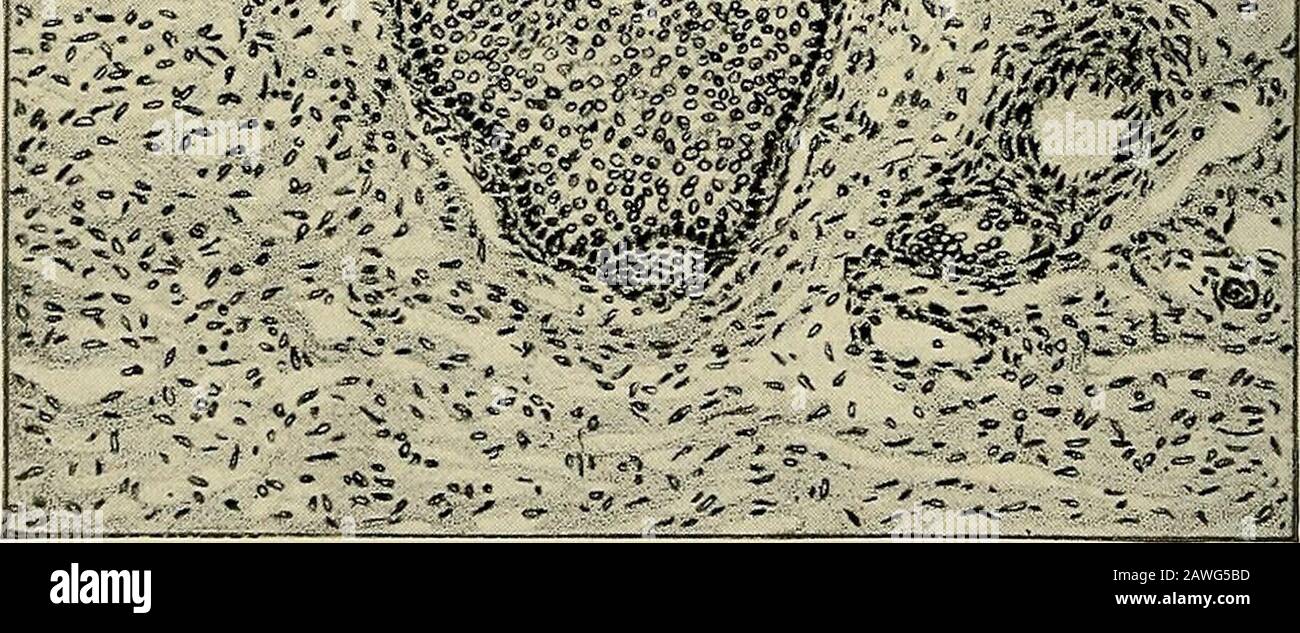 Dermoid cyst hi-res stock photography and images - Alamy