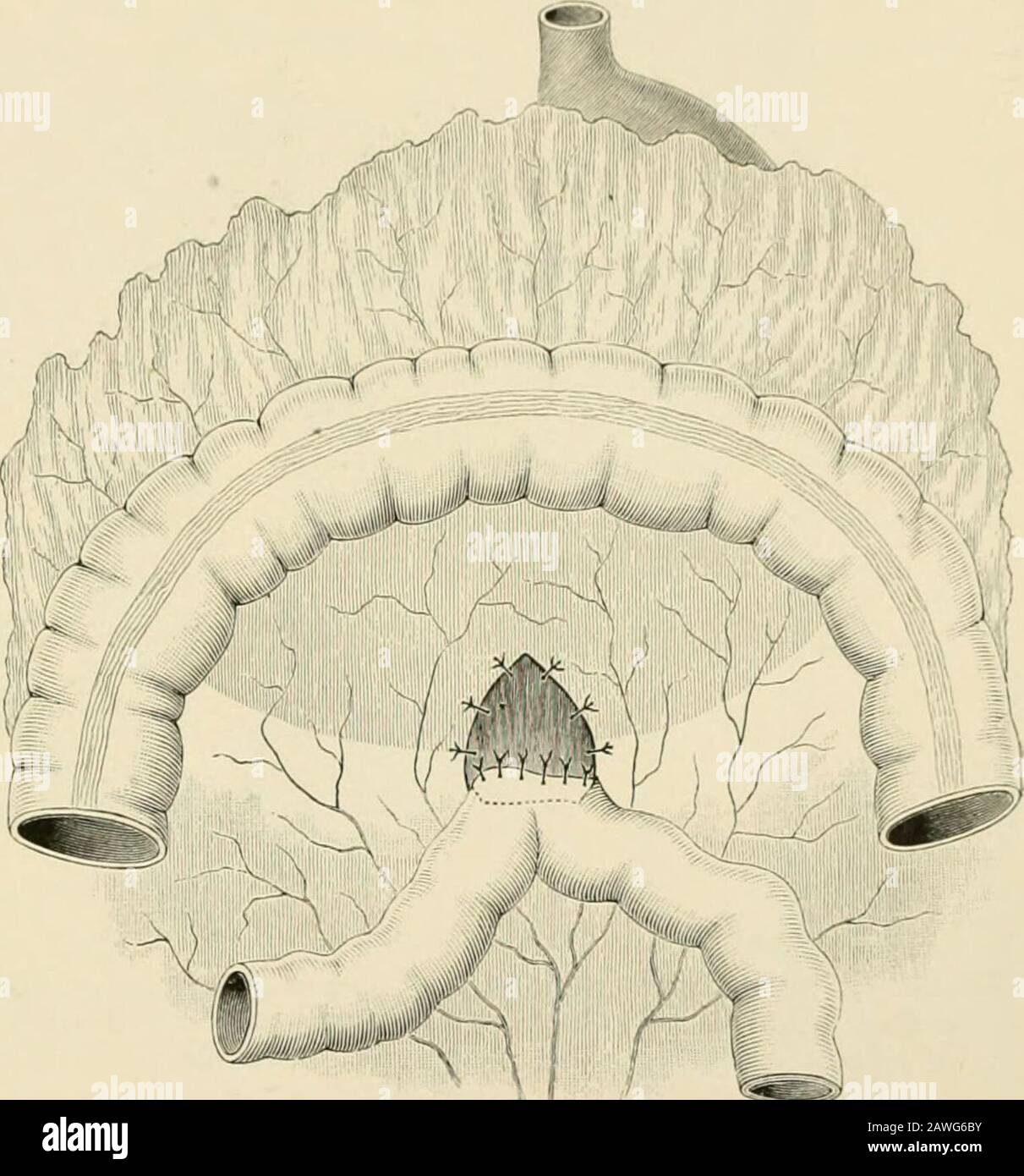 Transverse mesocolon hi-res stock photography and images - Alamy